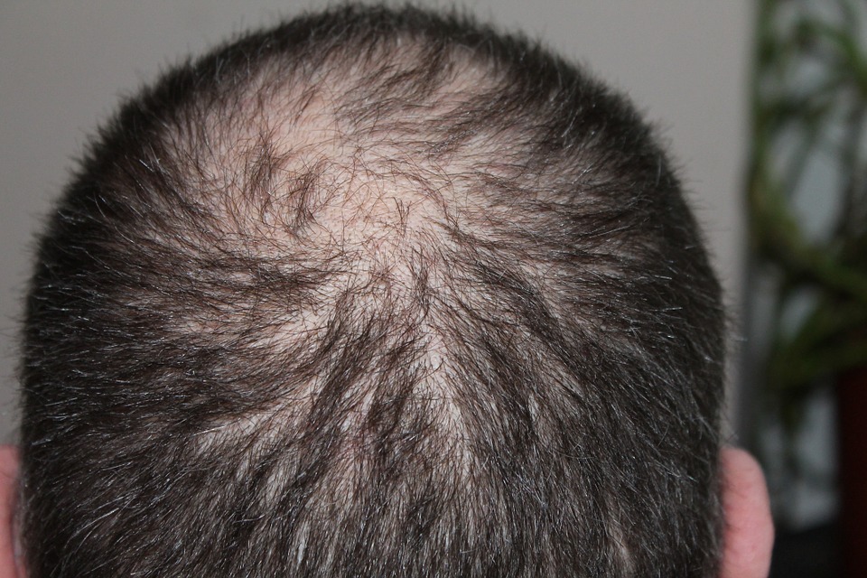 What is Hair Miniaturization and How to Deal With it? - Minoxidil Spray