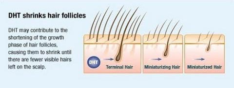 Hair Loss: Minoxidil Topical Treatment & Male Pattern Baldness